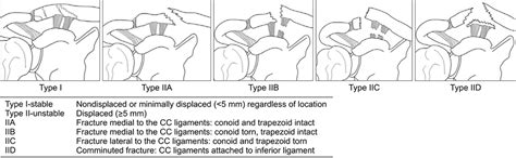 Current Concepts For Classification And Treatment Of Distal Clavicle Fractures