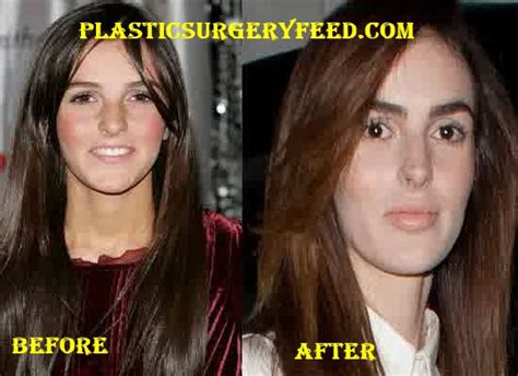 Ali Lohan Plastic Surgery Plastic Surgery Feed