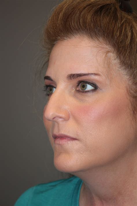 Patient 141113662 Submental Liposuction Before And After Photos Texas