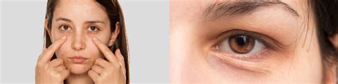 Dark Eye Circles Aglow Clinic