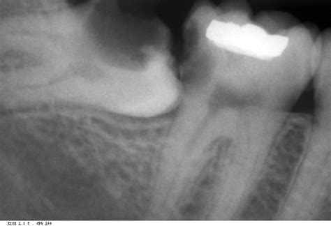 Apex Locator Instance Segmentation Dataset By Maassam Mohammed Anis