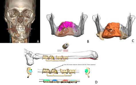 Cortical Plate Of Mandible