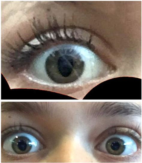 Mishaped Pupil