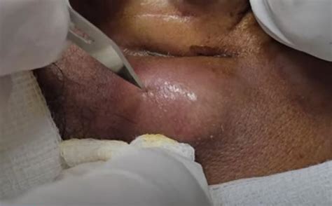 Post Aural Abscess Incision And Drainage New Pimple Popping Videos