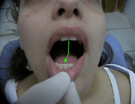 Limitation Of Mouth Opening And Jaw Movement With Deviation To The
