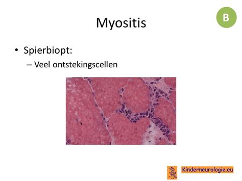 Myositis Kinderneurologie