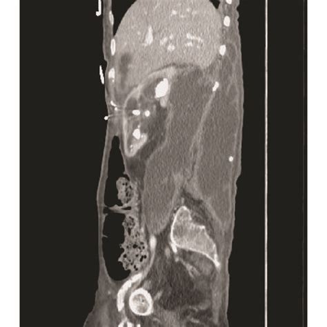 Sagittal Section Of A Ct Scan Of The Abdomenpelvis With Iv Contrast