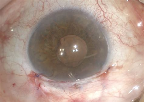 Cirugía de glaucoma MIGS con dispositivo Preserflo Microshunt Dr