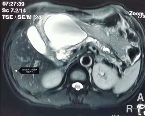 慢性胰腺炎合并胰腺假性囊肿的内镜下治疗