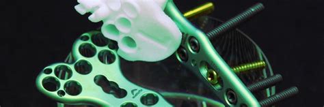 Wrist Plate To Help Fractures Heal Faster Optofab Adelaide
