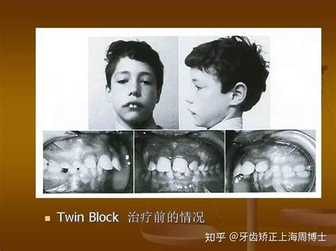 我为何选择放弃twinblock矫治器 知乎