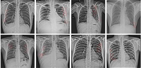 Example Of Fracture Annotations Of Our Dataset Download Scientific Diagram