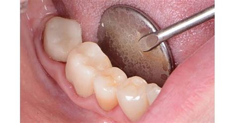 Long Lasting Solution For Endodontically Treated Teeth DMG America
