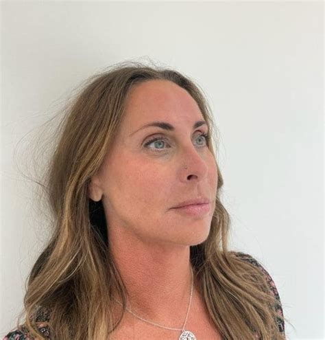Dermal Fillers Mediface Aesthetics Doncaster Aesthetics