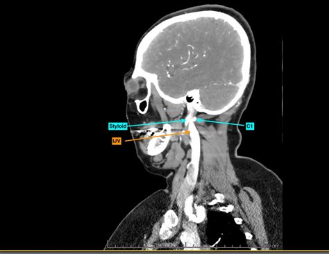 Xray Showing Elongated Styloid Process General Living With Eagle