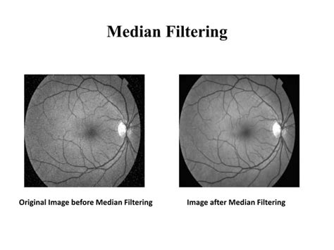 Diabetic Retinopathy Analysis Using Fundus Image Pptx Eye And Vision Conditions Diseases