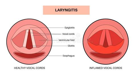 Laryngitis Medical Poster Stock Illustration Illustration Of Mouth