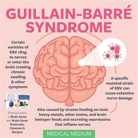 Guillain Barre Syndrome Symptoms Causes And Treatment 58 Off