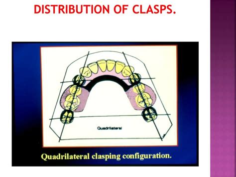 Ppt Planning The Design For Removable Partial Dentures Powerpoint