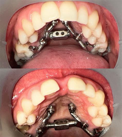 Marpe Palatal Expansion Kclinic In Knutsford