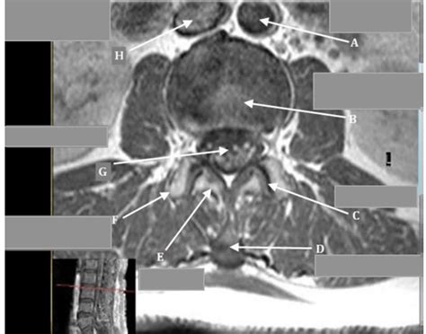 Mri Ax T1 Post Contrast Of The L Spine Anatomy Quiz