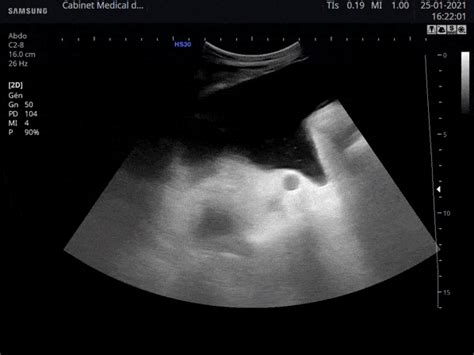 Ascite Carcinologique Societe Nationale Déchographie En Médecine Générale