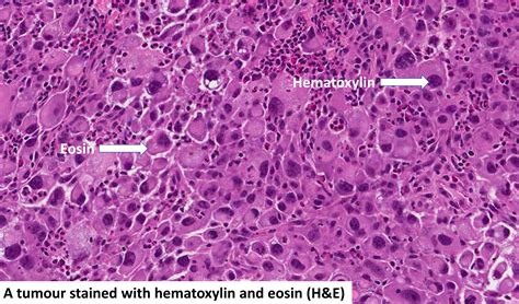 Hematoxylin And Eosin Myospherulosis
