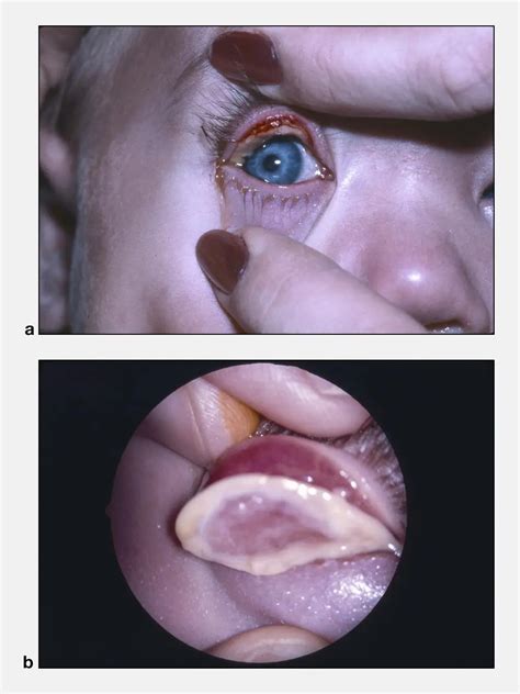 Ligneous Conjunctivitis American Academy Of Ophthalmology