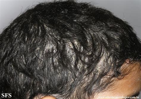 Pityriasis Amiantacea Nc Commons