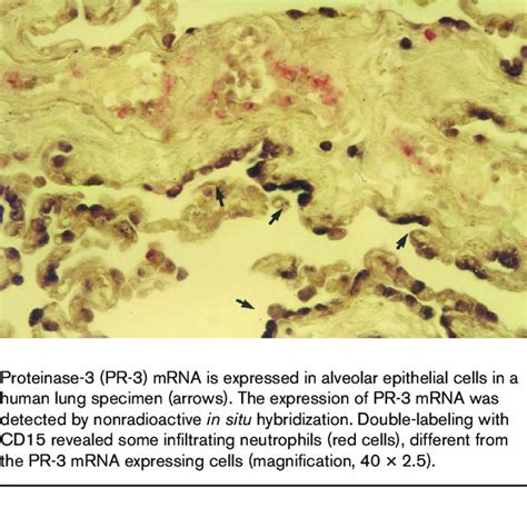 Proteinase 3 Pr 3 Mrna Is Expressed In Pneumocytes Type I In Human