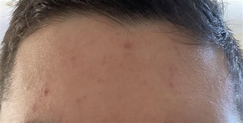 How To Manage My Hyperpigmentation Redness And Persistent Acne R