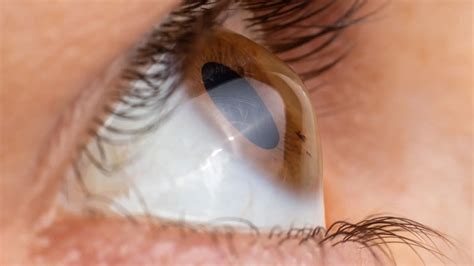 Lens Replacement Surgery For Keratoconus Expert Insights