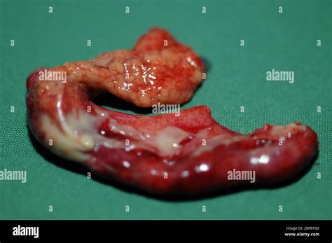 The Excised Appendix It Is Larger Than It Would Appear In A Normal Specimen Due To It Being