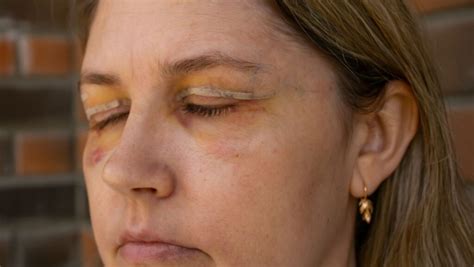 What To Do If You Have Botched Plastic Surgery And How To Recover