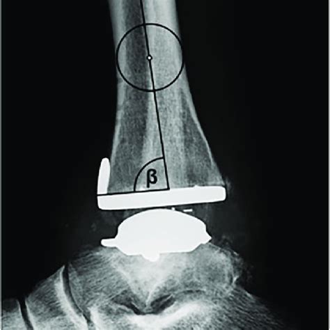 Grades Of Heterotopic Ossification After One And Three Years Not Only Download Scientific