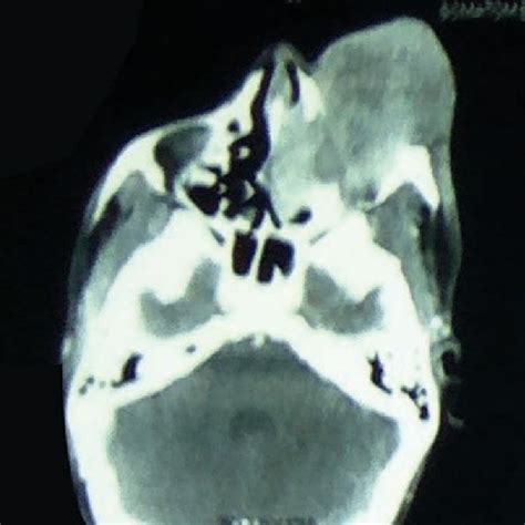 Cect Pns Contrast Enhanced Computed Tomography And Paranasal Sinuses