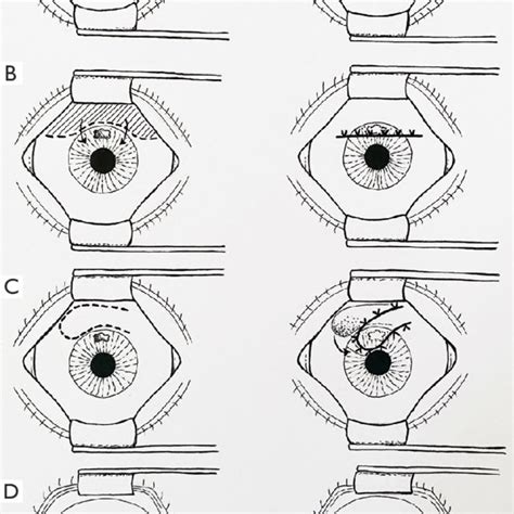 Conjunctival Flap Techniques A Bipedicle Flap B Partial Limbal Download Scientific