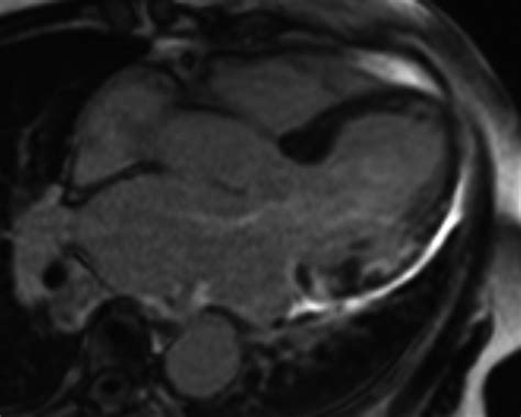 Late Gadolinium Enhancement Lge With Longitudinal Cardiac Magnetic