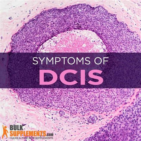 Dcis Ductal Carcinoma In Situ Symptoms Causes And Treatment