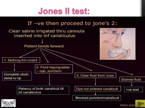 Noe Fracture Ppt