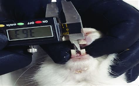 Direct Manual Intra Oral Measurement Of Interproximal Space With