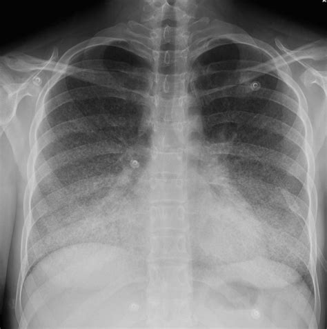 000 Micronodules Lungs