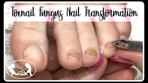 What Causes Thick Toenails In Elderly Nail Ftempo