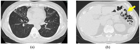 Chest Ct A Showing Nodular And Bronchiectatic Lesions In The Right Download Scientific