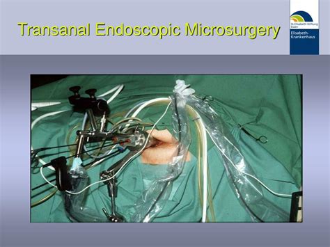 Ppt Local Resection Of Rectum Tumors Powerpoint Presentation Free Download Id6094261