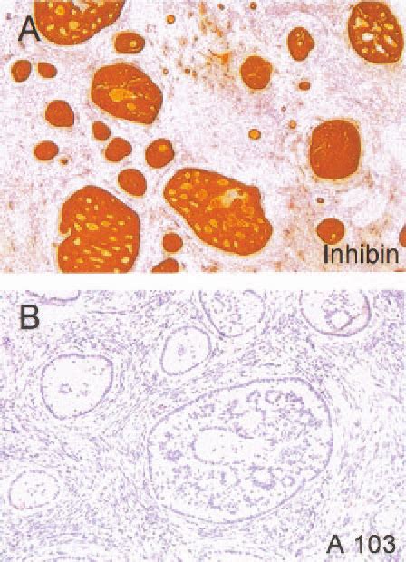Sex Cord Tumor With Annular Tubules Sctat Tumor Cells Are Strongly Download Scientific