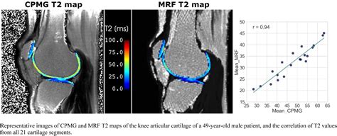 T2 Magnetic Resonance Fingerprinting In Global And Focal Knee Cartilage