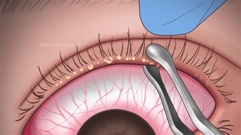 Asmr 속 시원한 눈꺼풀 피지 압출 애니메이션 눈기름샘 짜기 Satisfying Eyelid Sebum
