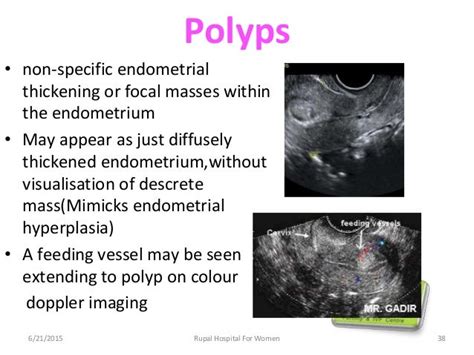 Ultrasound In Infertility