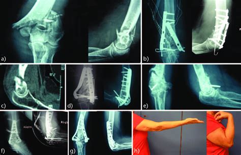 Fracture Of The Distal Humerus With Severe Comminution In 48 Year Old Download Scientific